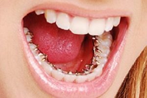 orthodontie linguale Win - spécialité du cabinet du Dr Chassaing